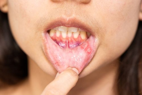 Unpacking Oral Ulcers: Causes, Types, and Distinguishing